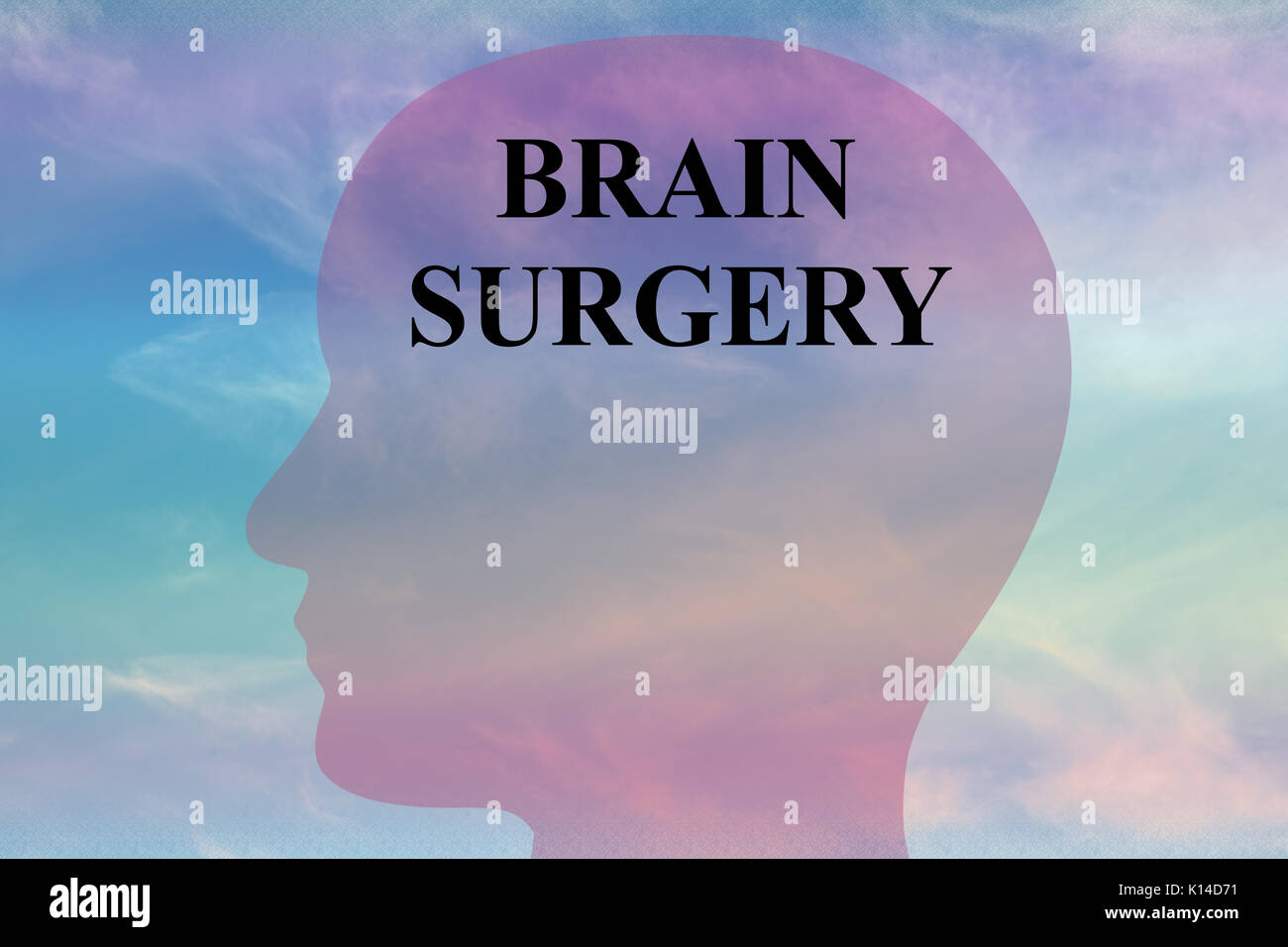 Render illustration of "BRAIN SURGERY" title on head silhouette, with ...