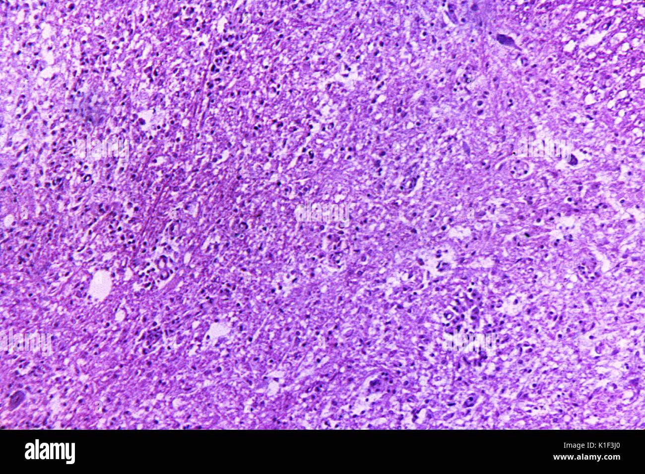 Photomicrograph of the cervical spinal cord affected by polio type-III ...