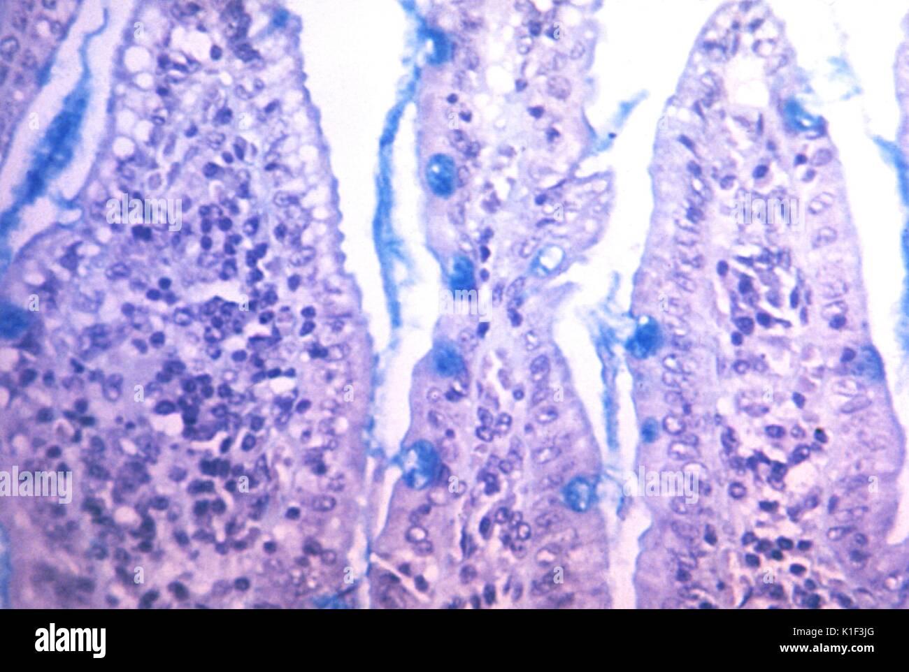Vibrio cholerae causing increased mucous production seen in this ...