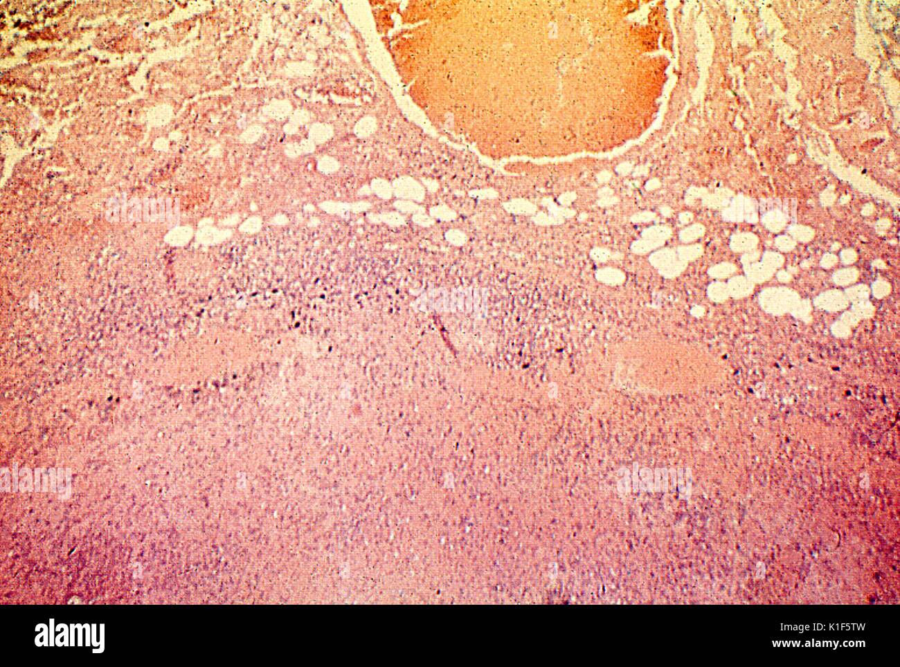 Necrosis of lymph node due to anthrax. 33 year old white male who died ...