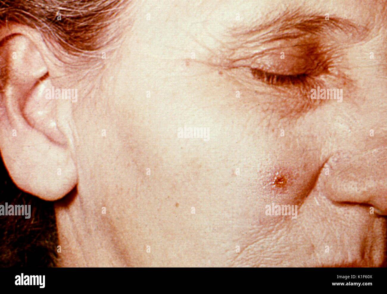 Anthrax, skin of face, 4th day. 53 year old female, employed 10 years ...