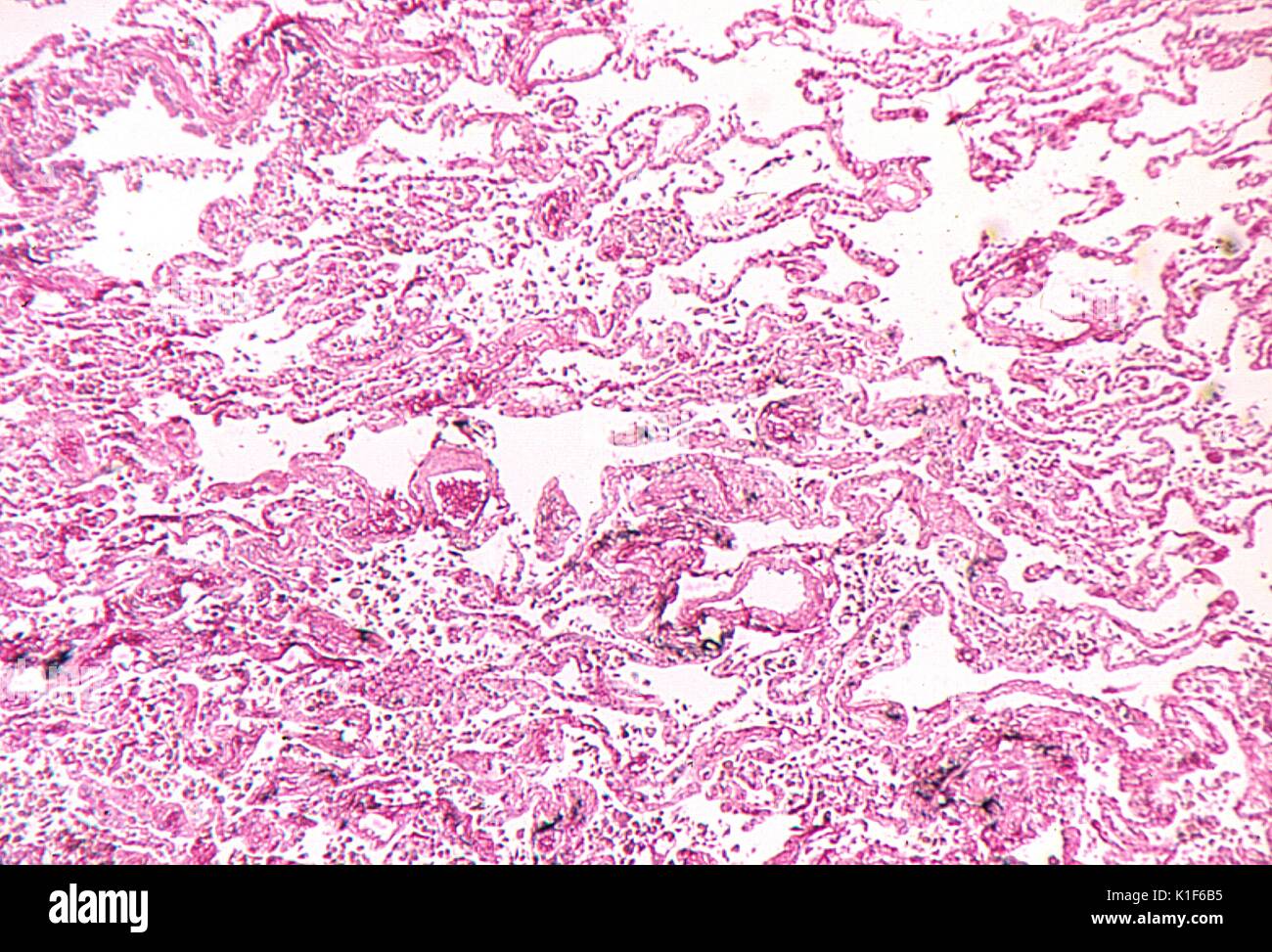 Anthrax Inhalation Lung Tissue Sample