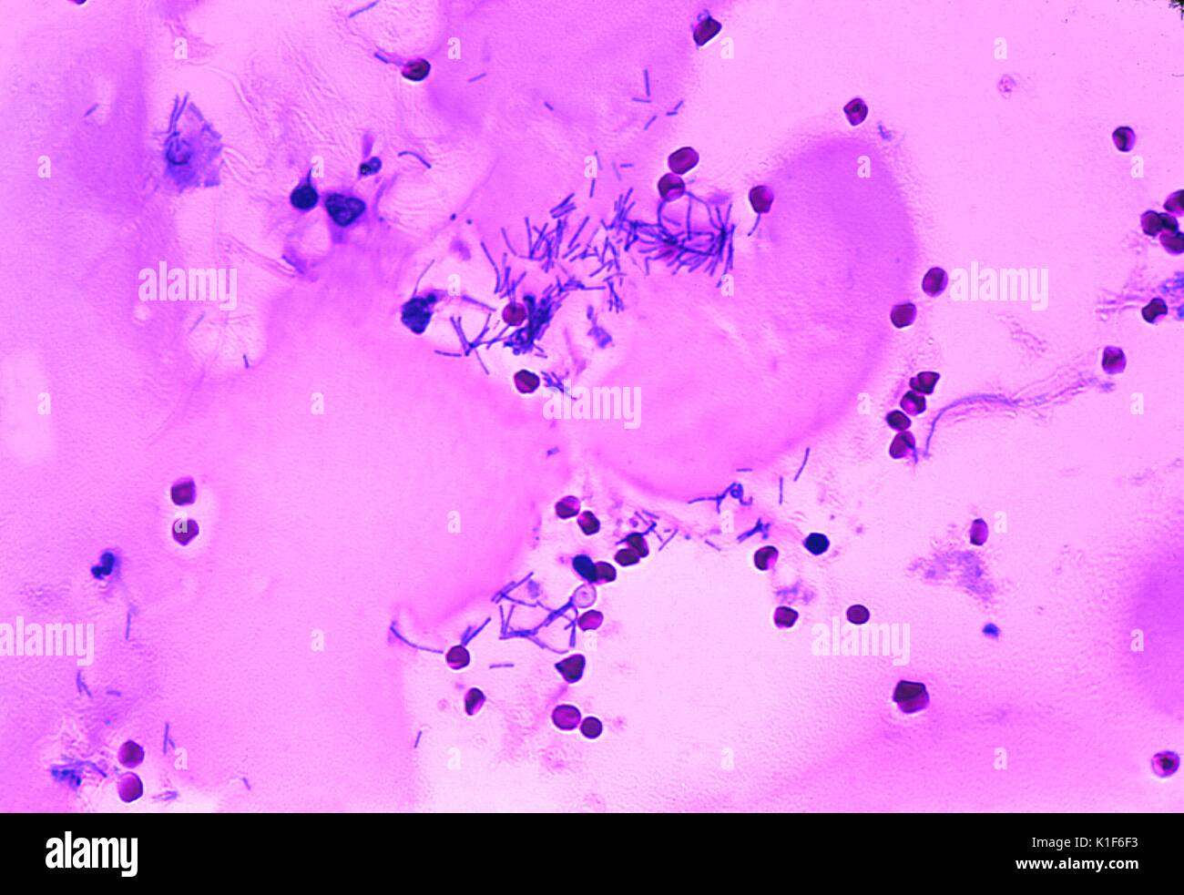 Photomicrograph of serohemorrhagic meningitis in a case of fatal human ...