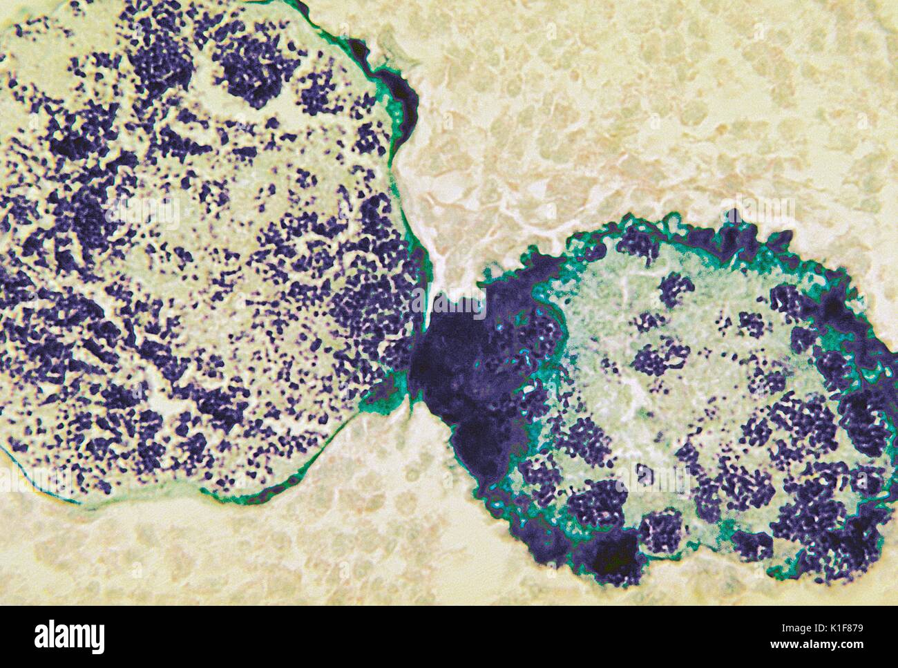 Histopathology of botryomycosis, foot. Methenamine silver stain. Image ...