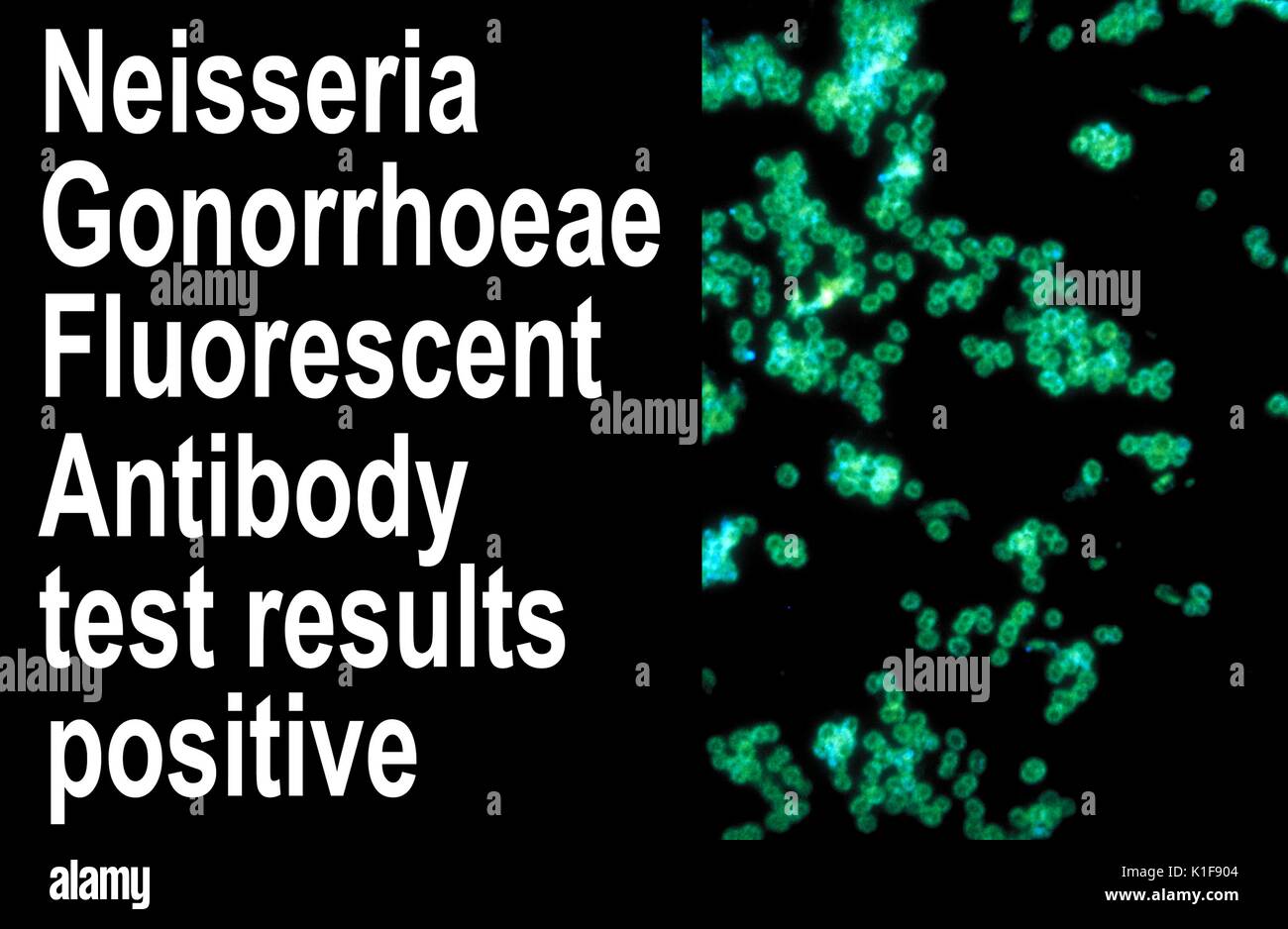 Positive FA test for Neisseria gonorrhoeae . This strain was penicillin ...