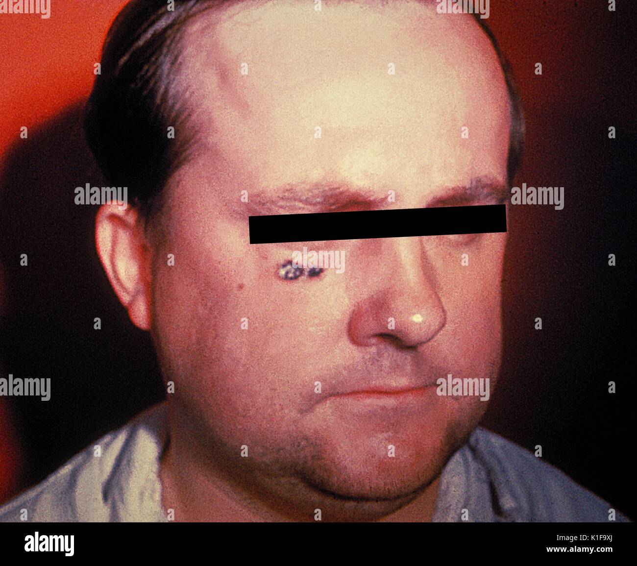 Lichenification Face
