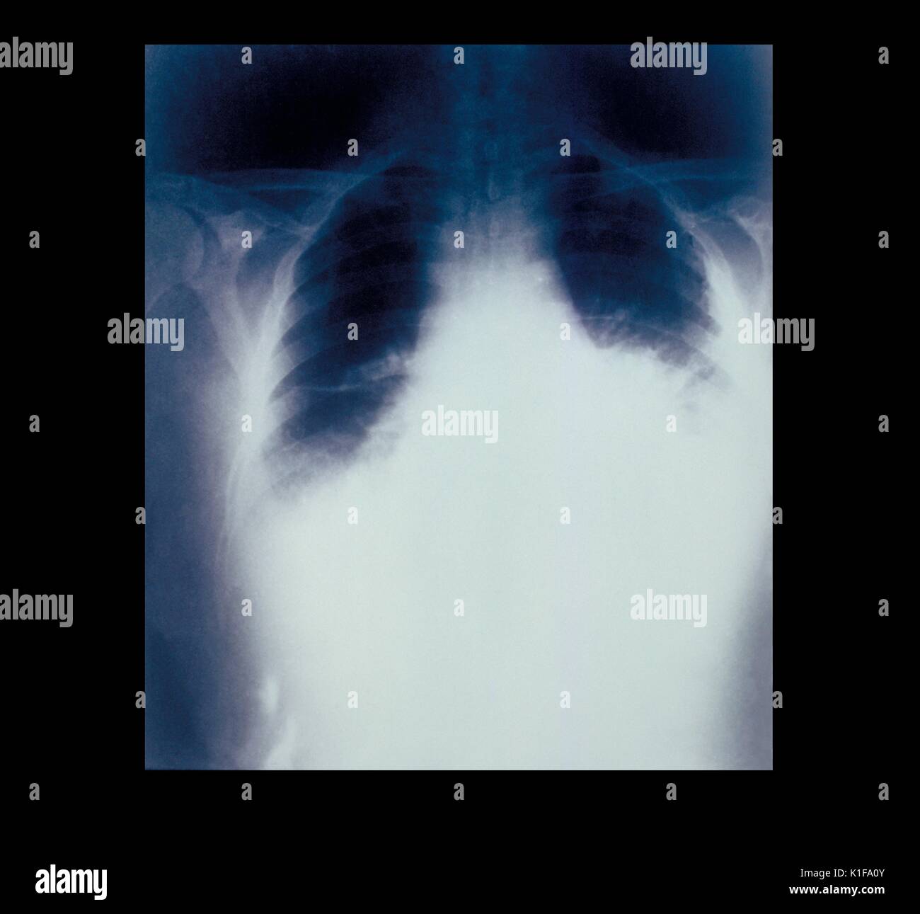 This anteroposterior (AP) chest radiograph showed a widened mediastinum ...