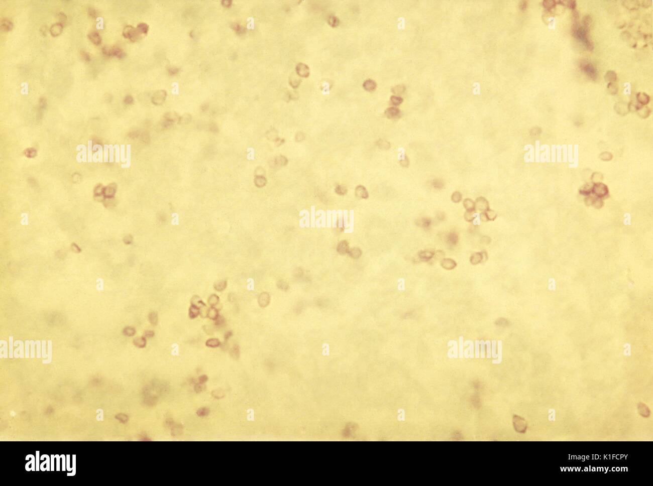 Yeast forms of Histoplasma capsulatum in tissue. Histopathology of ...