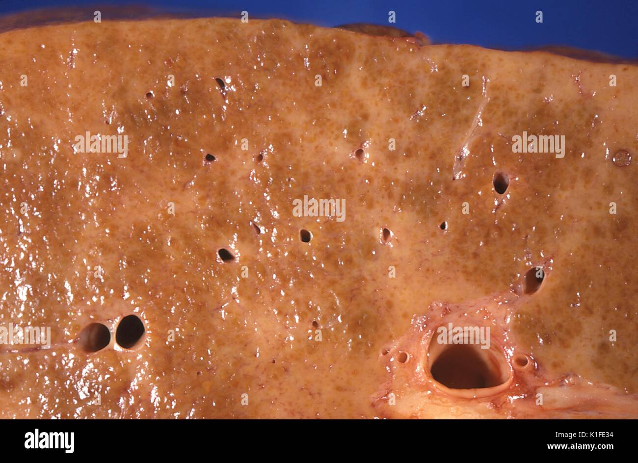 Alcoholic cirrhosis, liver. This cut surface of a gross autopsy ...