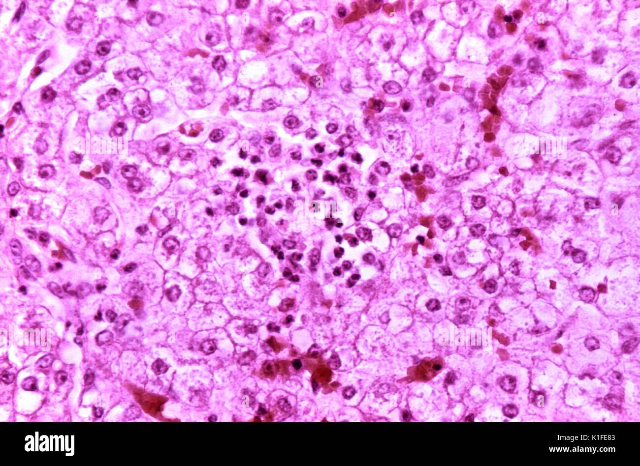 Autopsy liver specimen hi-res stock photography and images - Alamy