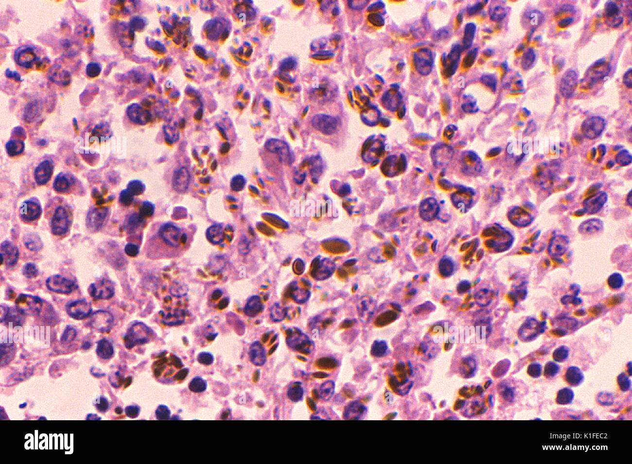 Hamazaki-Wesenberg bodies, lymph node, Histopathology of lymph node ...