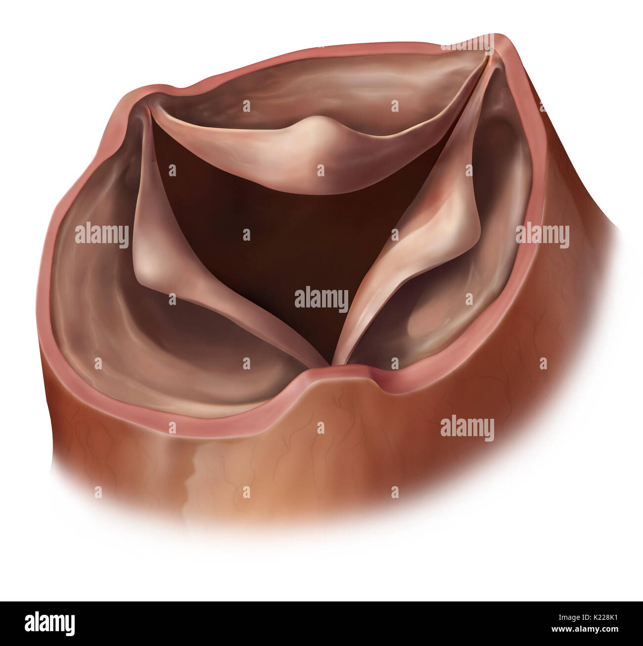 When it opens to let the blood pass, the edges of a healthy valve fold ...