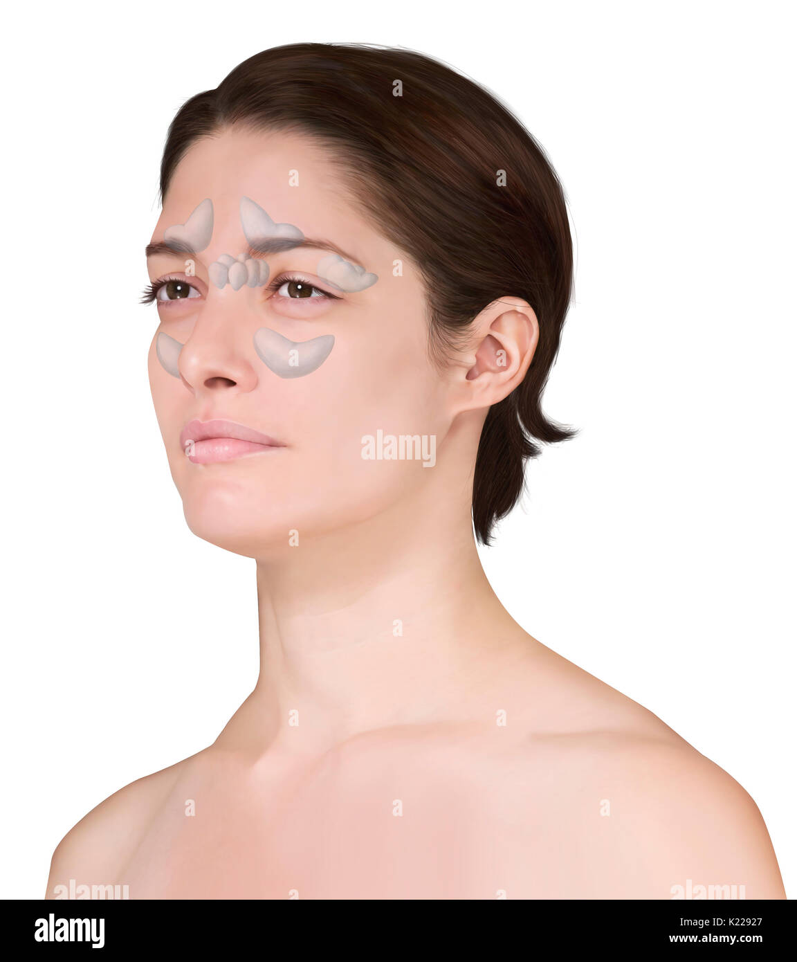 The paranasal sinuses are cavities located in the bones of the face ...