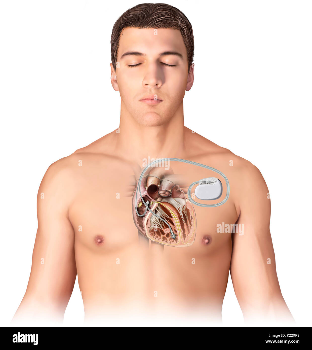 Electronic implant that emits an electrical impulse in order to ...