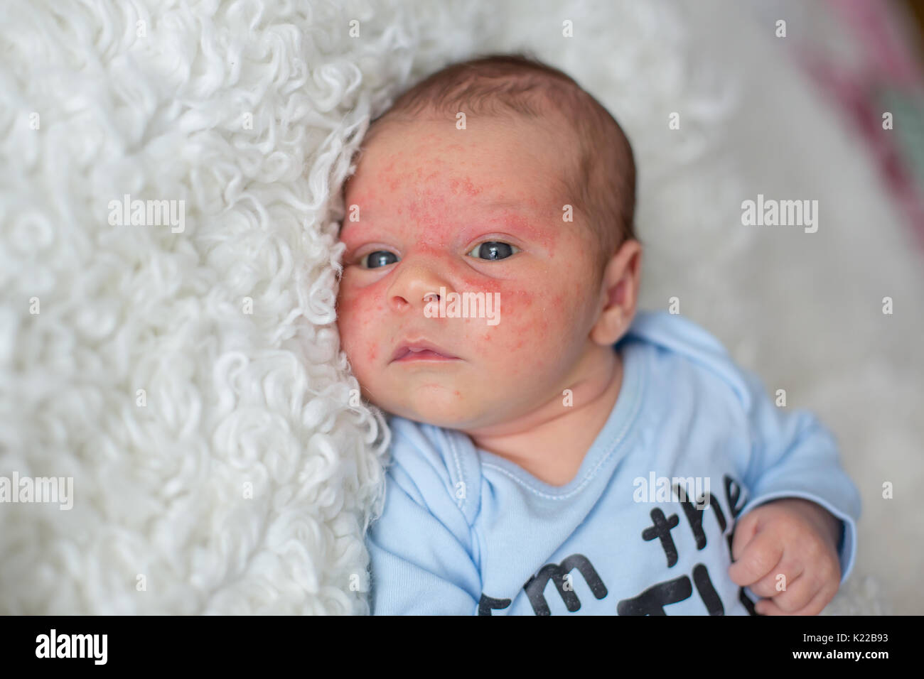 Little newborn baby looking, baby with scin rash, child dermatitis ...
