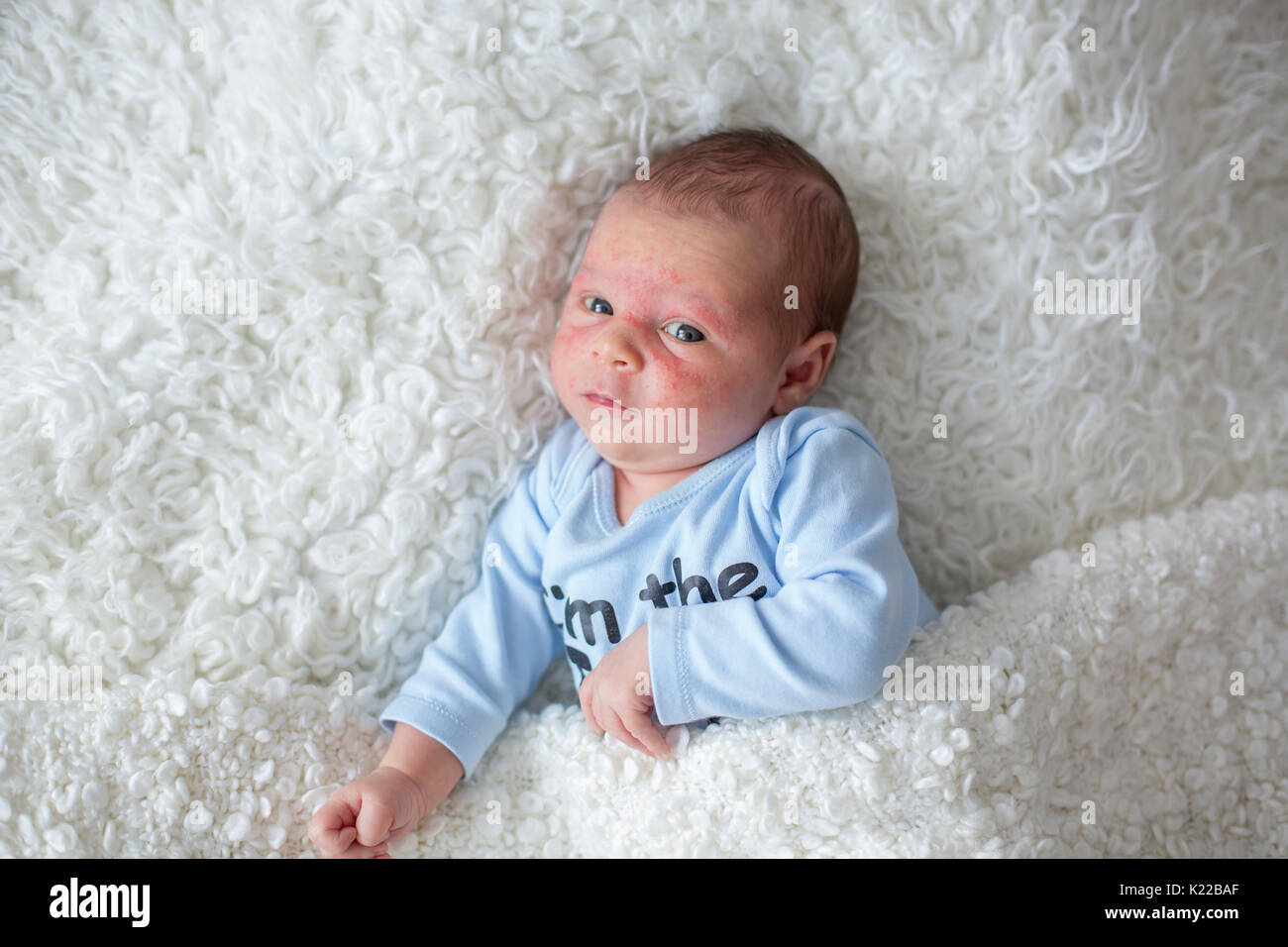 Little newborn baby looking, baby with scin rash, child dermatitis ...