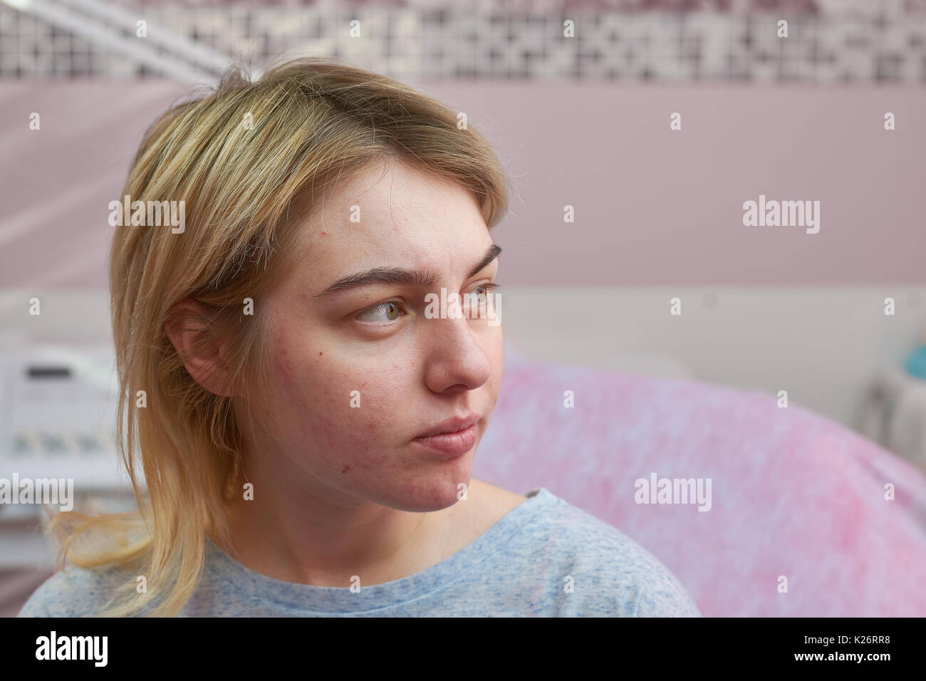 Caucasian girl with acne. Problematic face skin. Symptoms of allergic ...