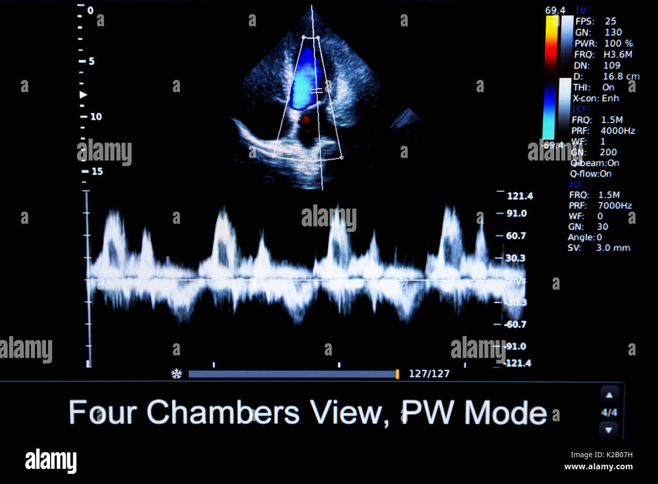 Ultrasound heart chambers hi-res stock photography and images - Alamy