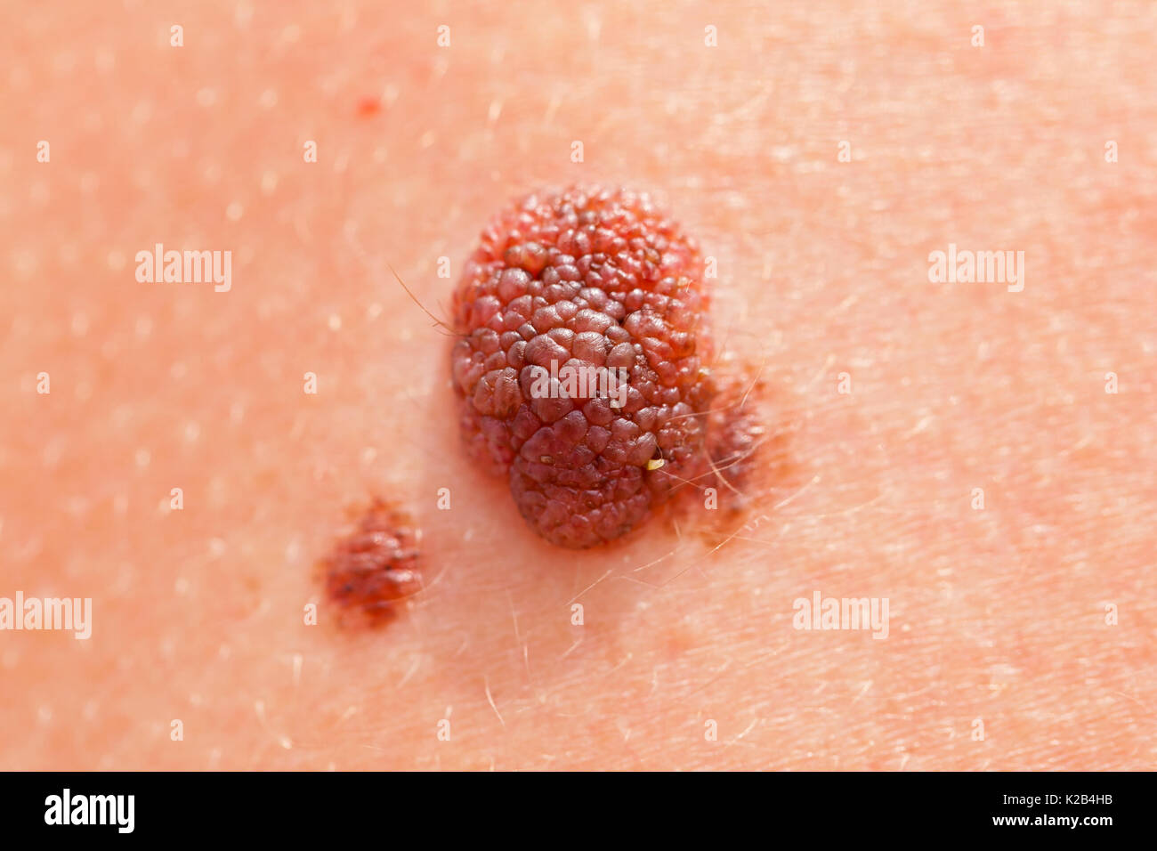 Close up picture of brown birthmark - nevus on human skin Stock Photo ...