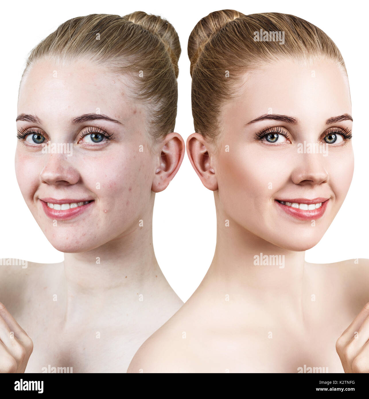 Young woman with acne before and after retouch Stock Photo - Alamy
