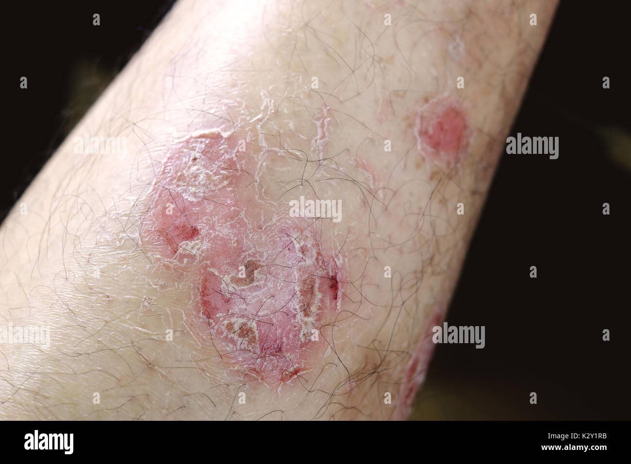 Plaque psoriasis hi-res stock photography and images - Alamy