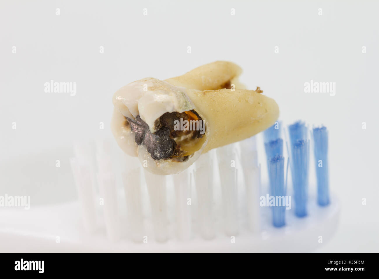 Tooth decay dental caries and tooth brush on background Stock Photo - Alamy