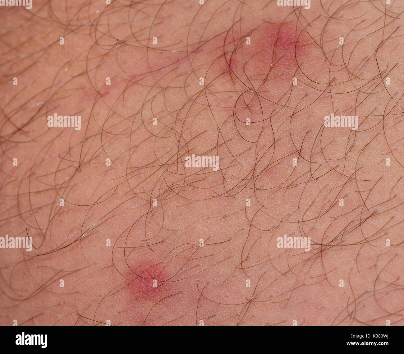 Scab And Itchy Stock Photos & Scab And Itchy Stock Images - Alamy