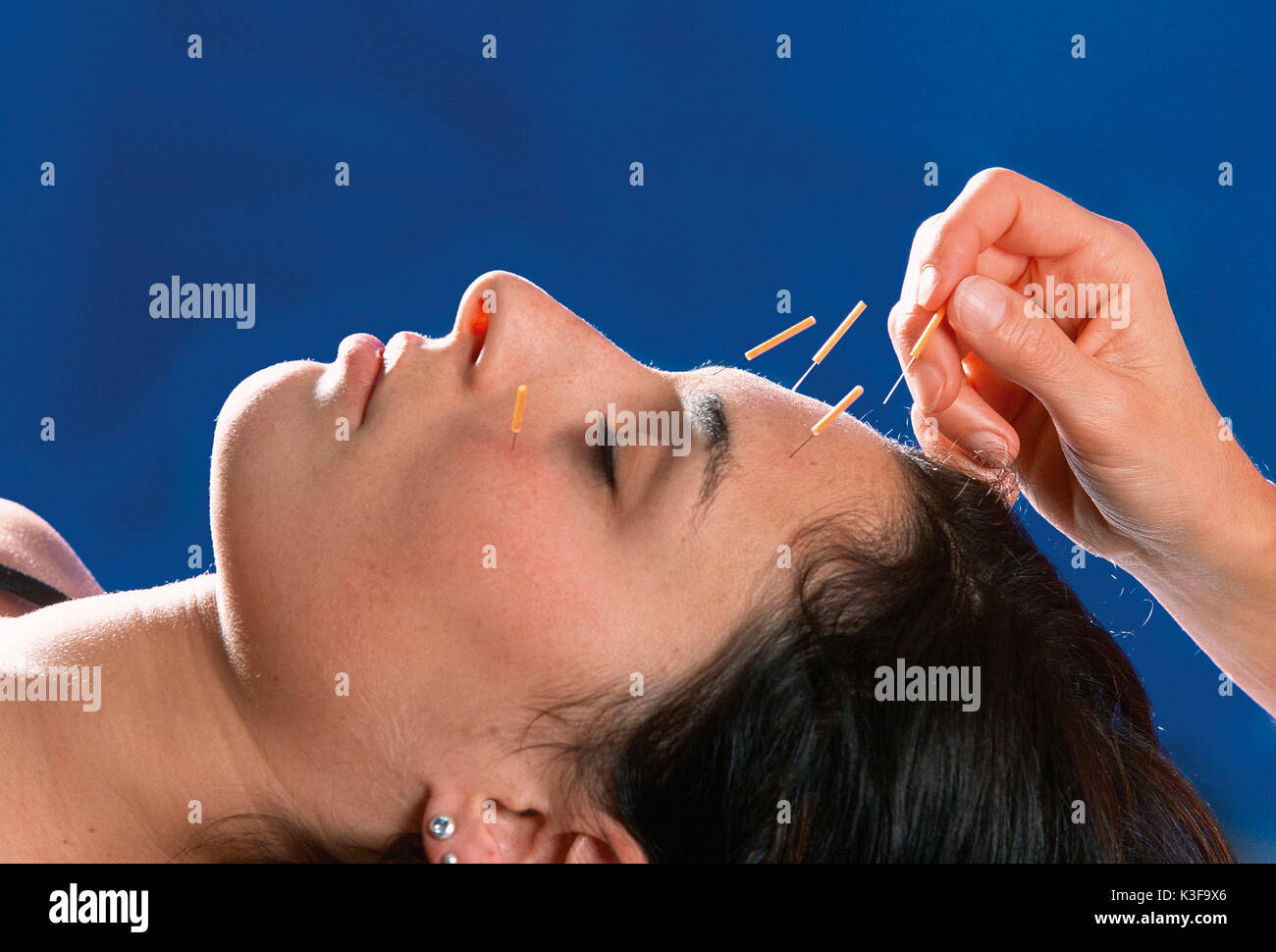 Acupuncture procedure hi-res stock photography and images - Alamy
