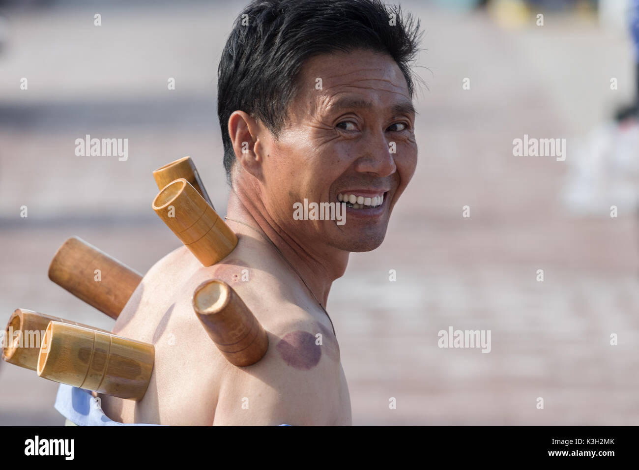 Cupping therapy hi-res stock photography and images - Alamy