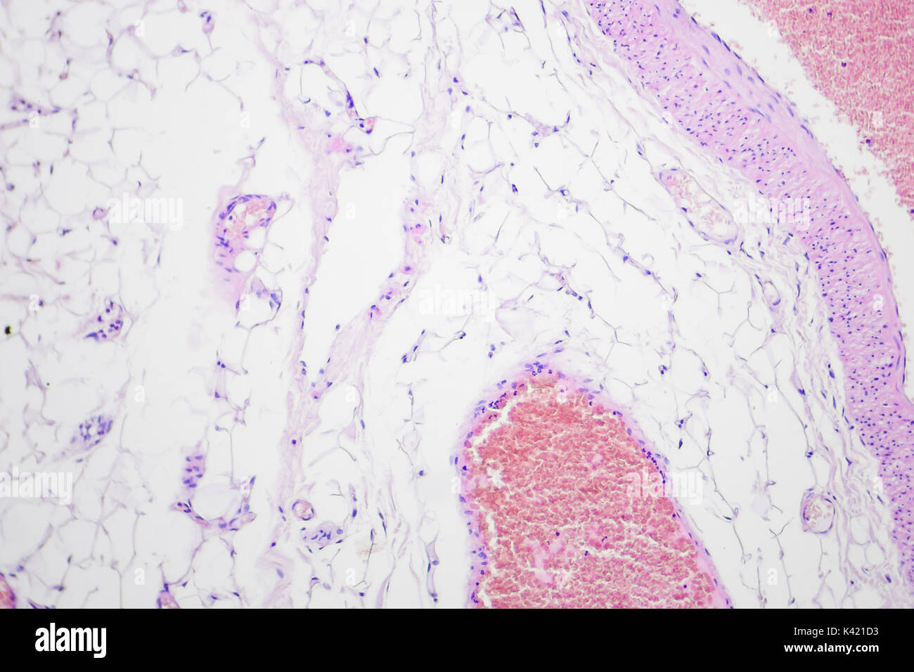 Colon cancer microscopic photography, magnification x100 Stock Photo ...