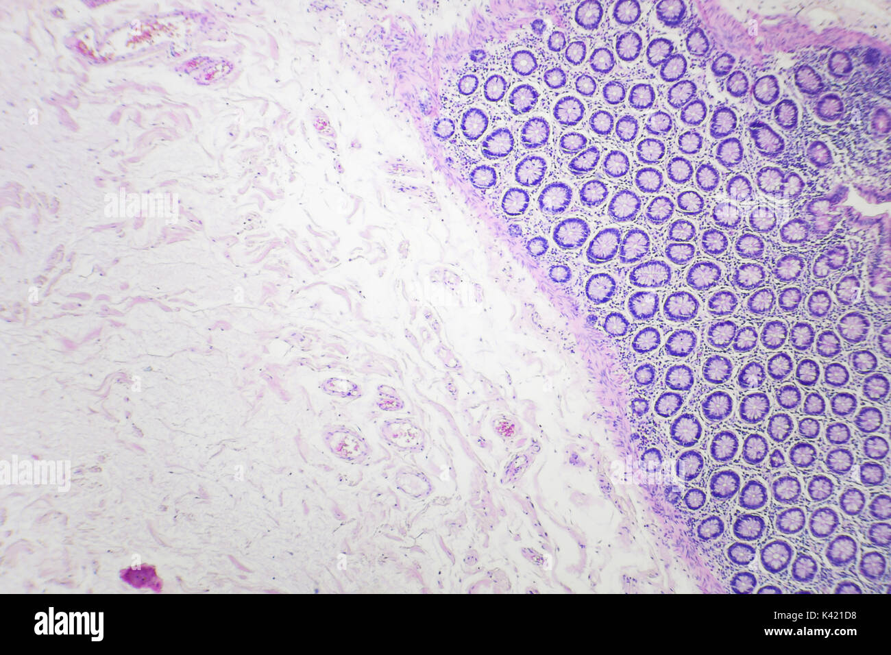 Colon cancer microscopic photography, magnification x40 Stock Photo - Alamy