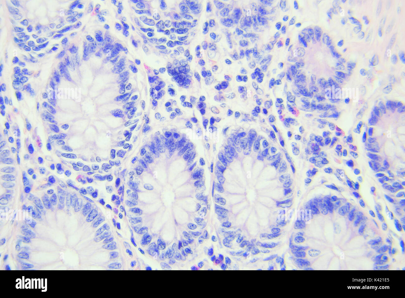 Colon cancer microscopic photography, magnification x400 Stock Photo ...