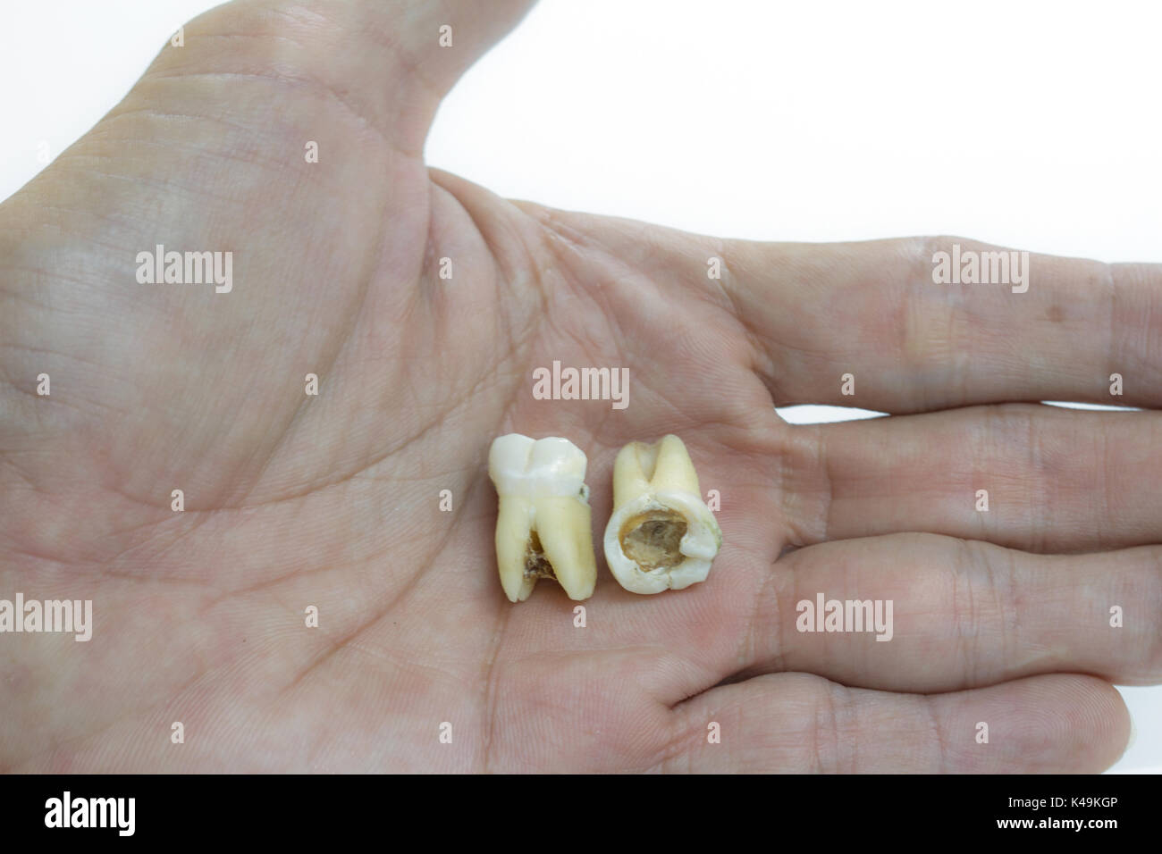 Hand holding molar hi-res stock photography and images - Alamy