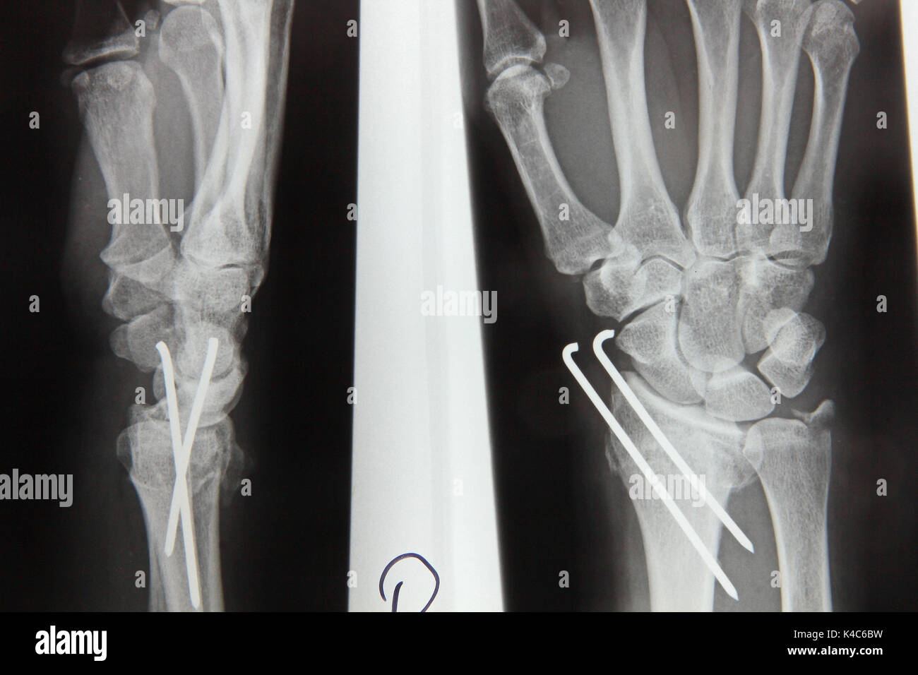 X-Ray Image Of Bones Stock Photo - Alamy