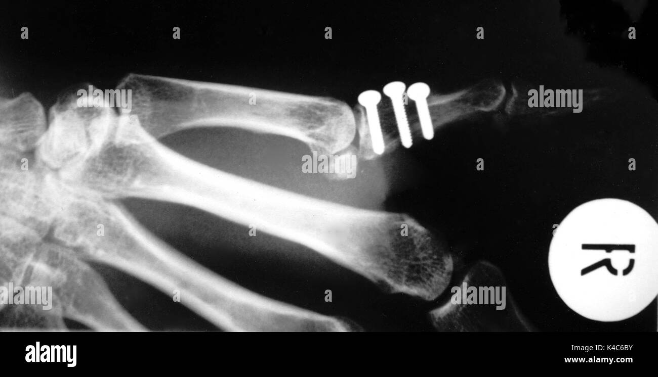 Hand Bones Of A Woman With Nails On Radiograph Stock Photo - Alamy