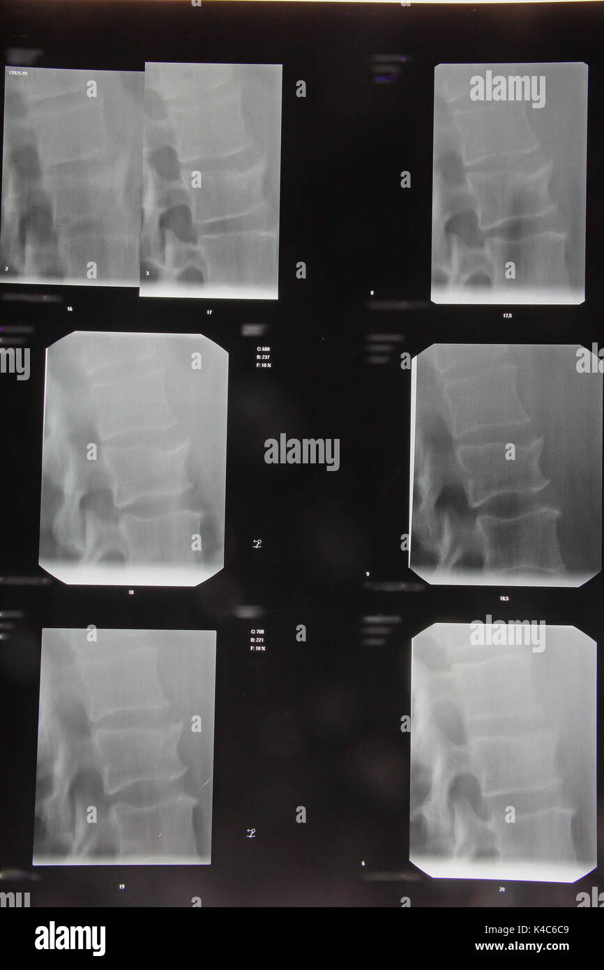 Radiography hi-res stock photography and images - Alamy