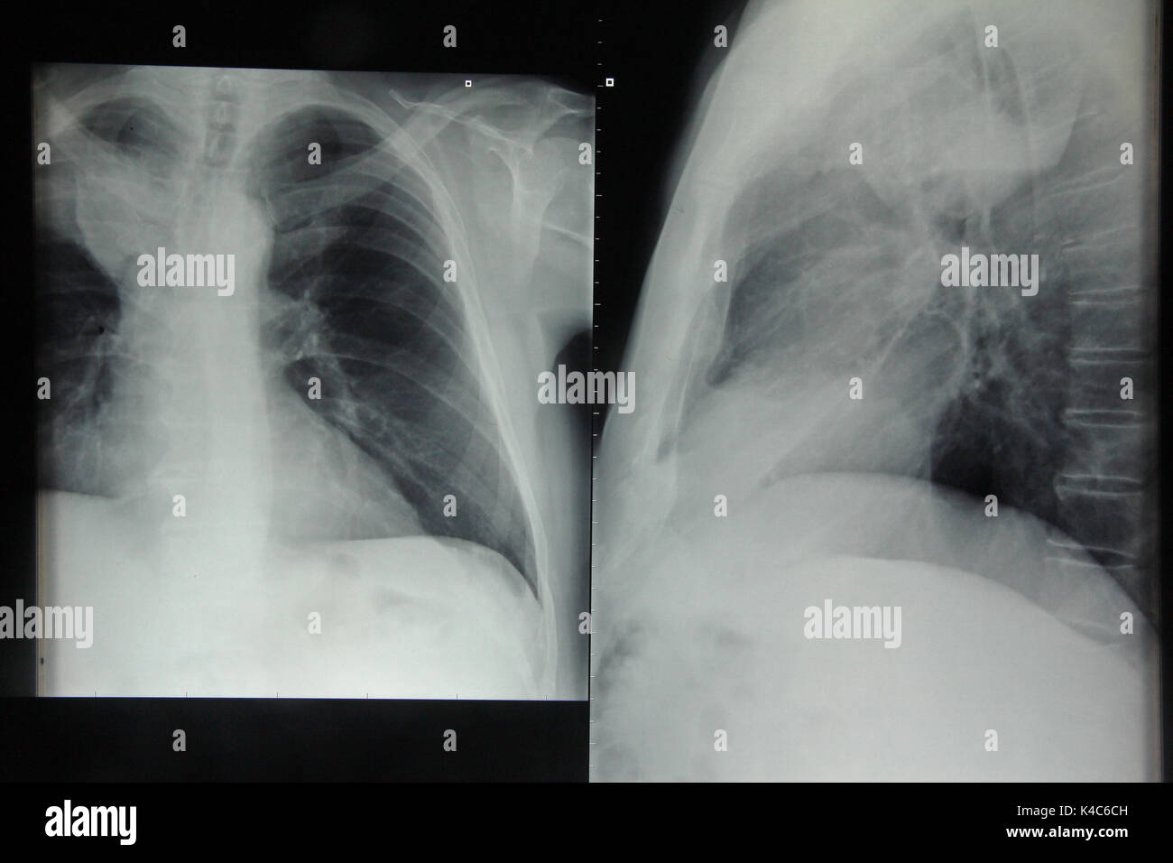 X-Ray Image Of A Lung Stock Photo - Alamy