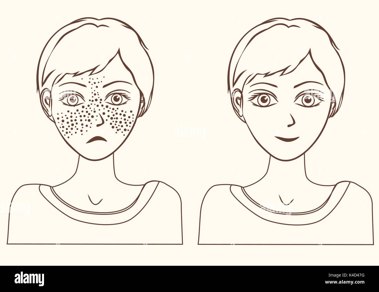 Freckles teen Stock Vector Images - Alamy
