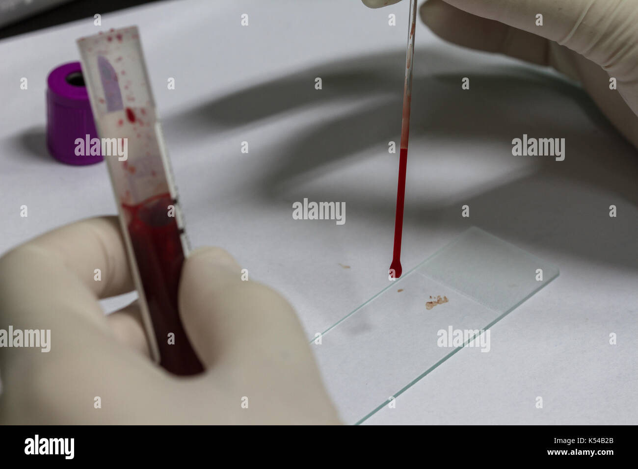 doctor will put a drop of blood on the sterile slide, medicine ...