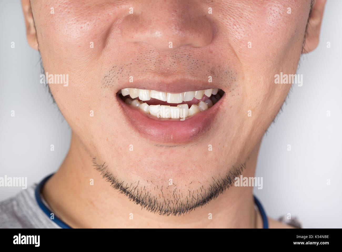 ugly smile dental problem. Teeth Injuries or Teeth Breaking in Male ...