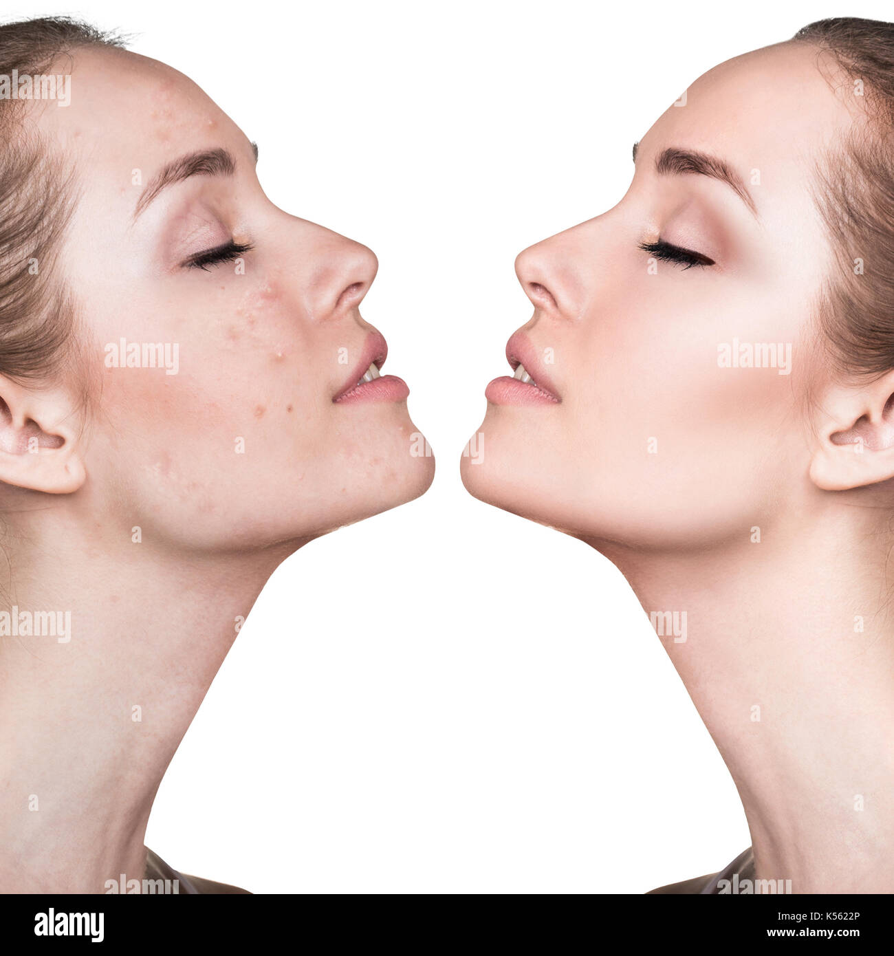 Woman with problem skin before and after treatment and make-up over ...