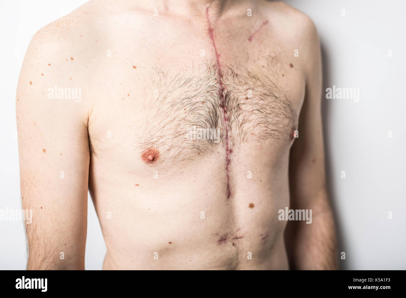 Open heart surgery scar hi-res stock photography and images - Alamy Open heart surgery scar hi-res stock photography and images - Alamy
