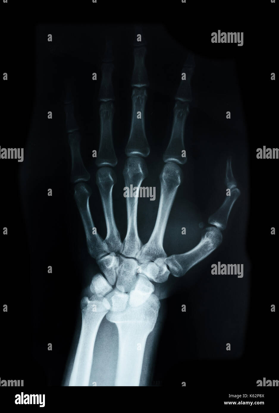 Carpal bones hi-res stock photography and images - Alamy