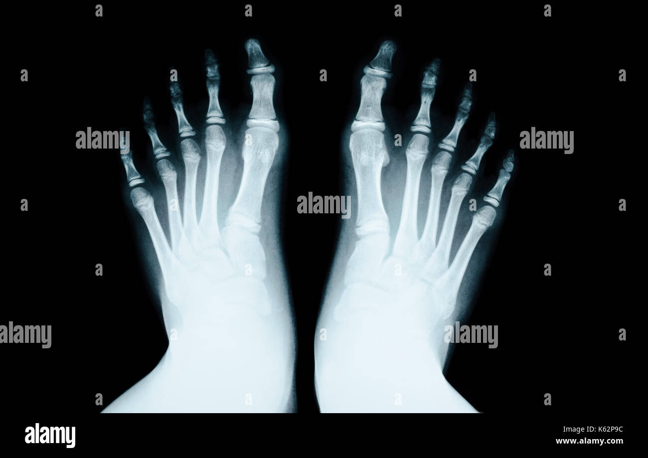 Foot x ray rheumatoid arthritis hi-res stock photography and images - Alamy