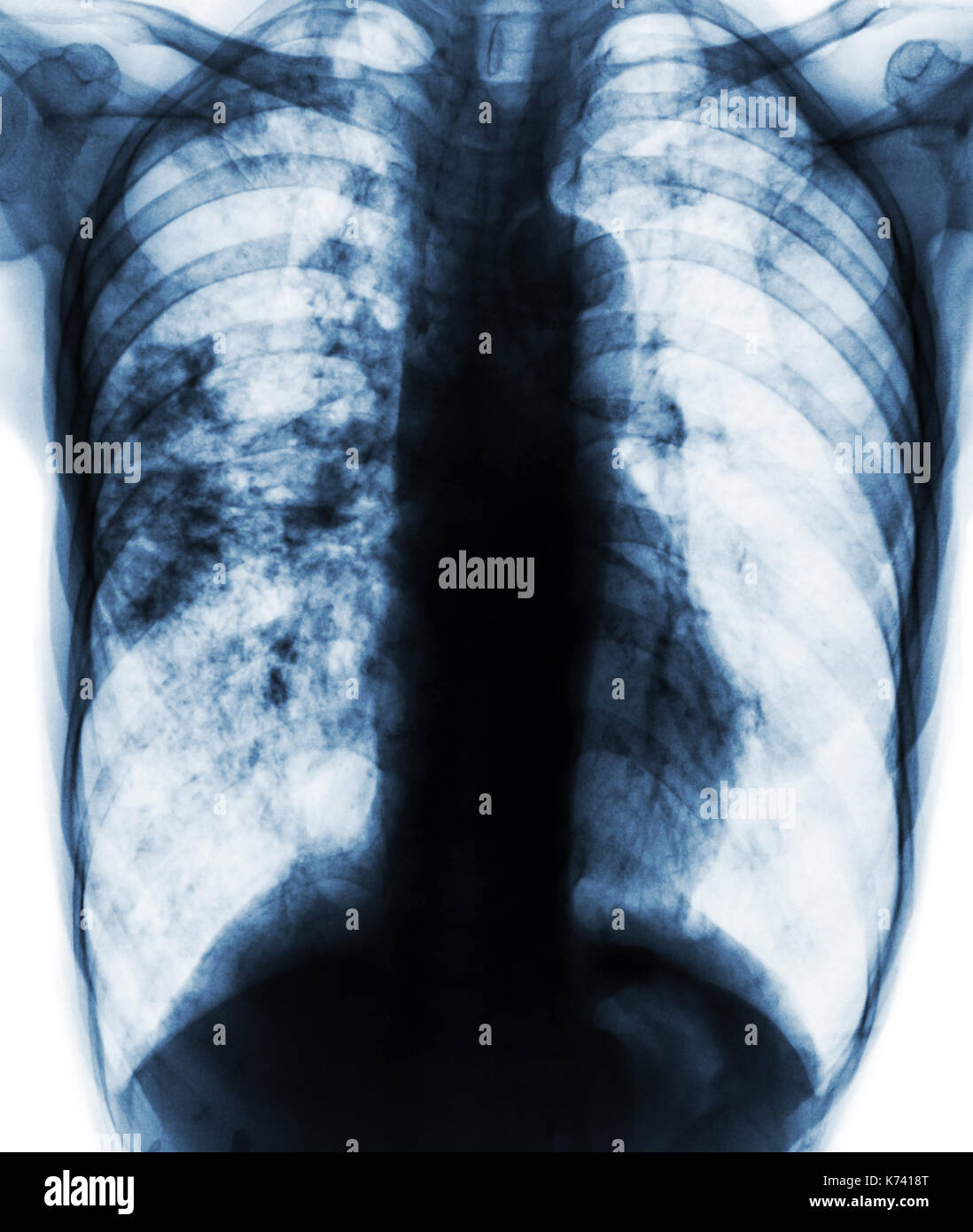 Pulmonary tuberculosis chest x ray interstitial hi-res stock ...