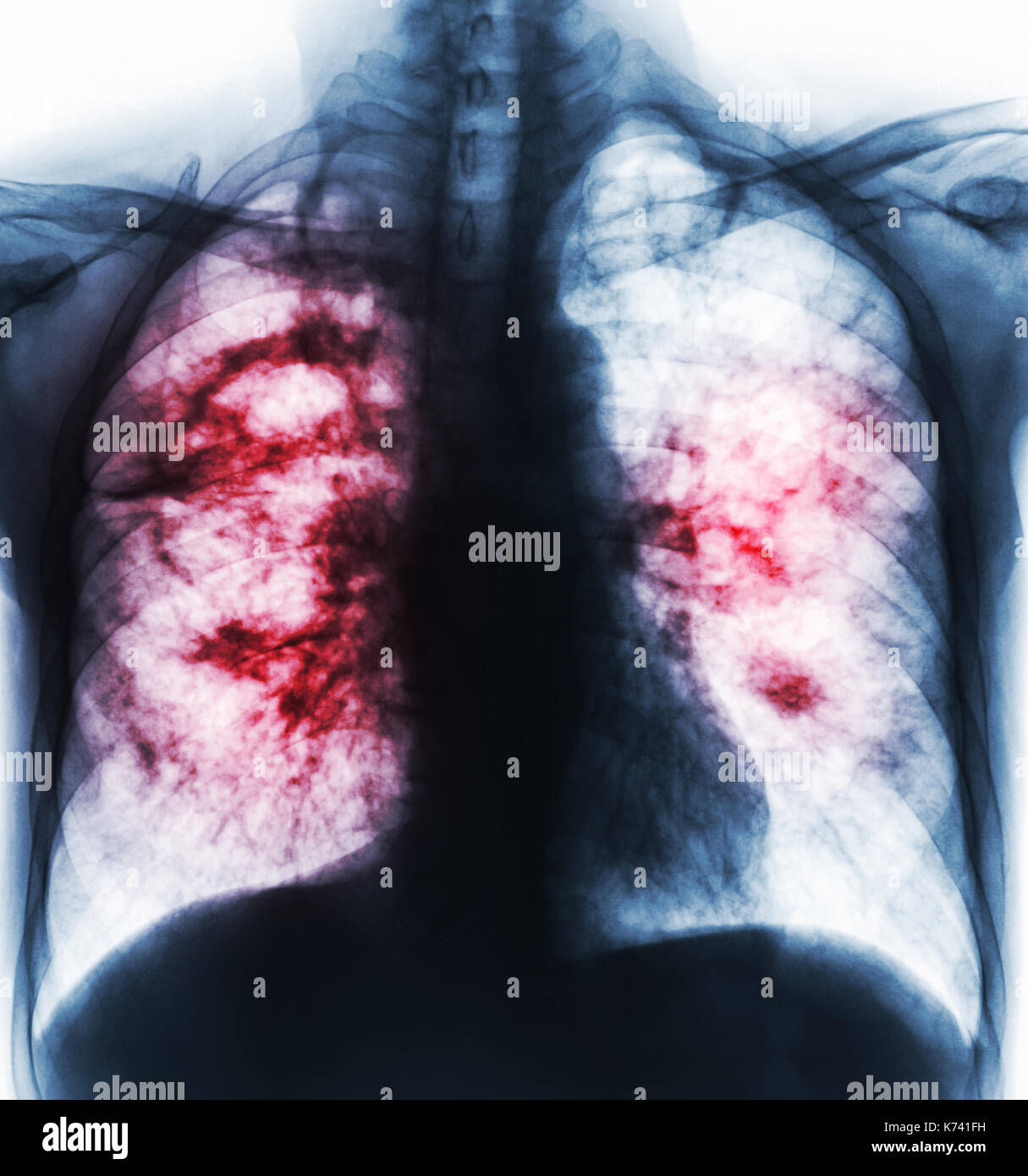 Pulmonary tuberculosis . Film x-ray of chest show cavity at right lung and interstitial ...