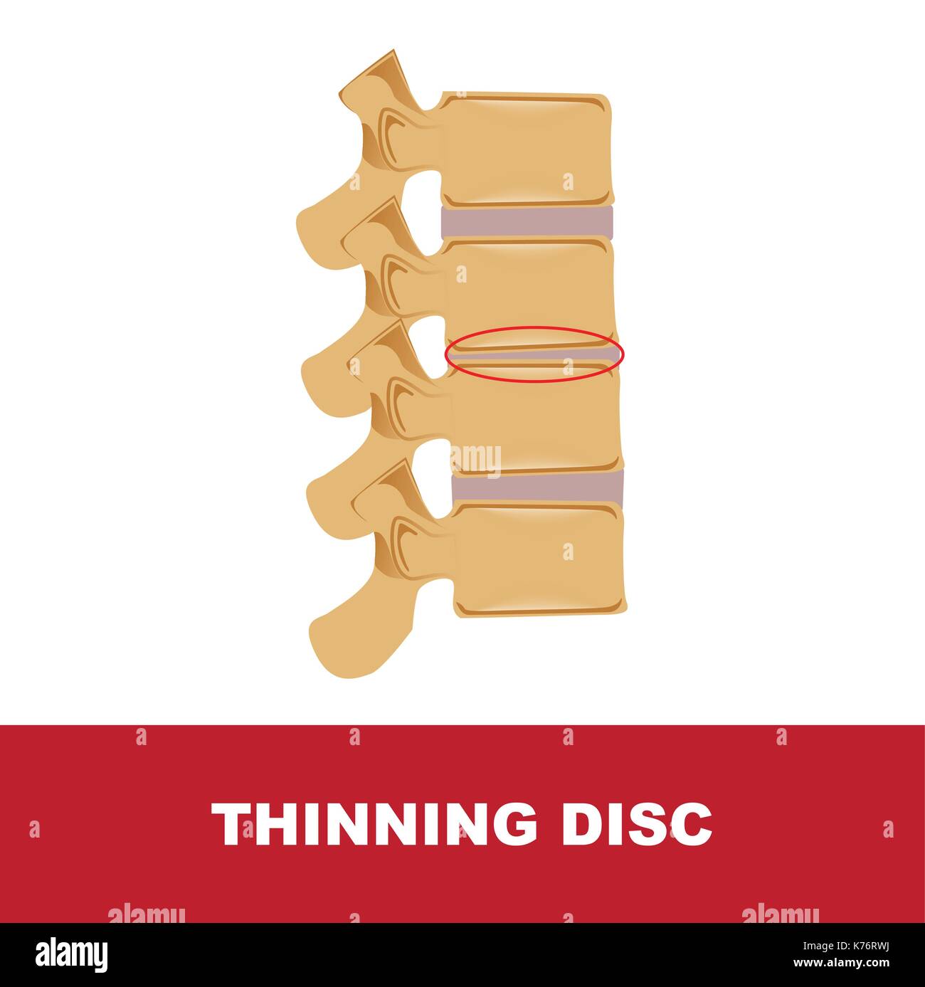Bulging disc hi-res stock photography and images - Alamy