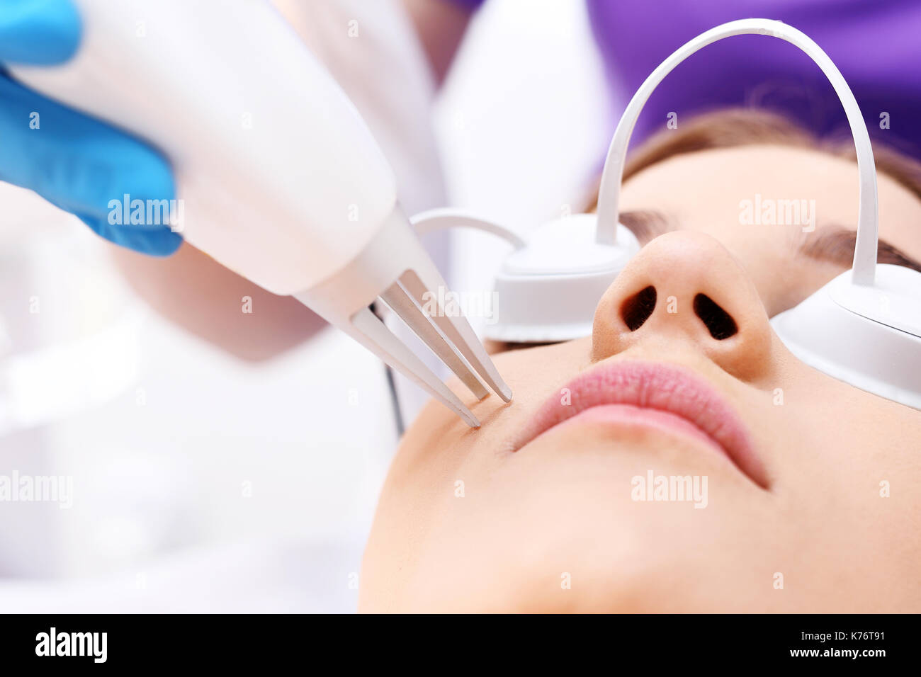 Laser lightening of pigmented lesions on the face Stock Photo - Alamy
