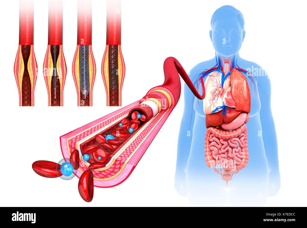 Illustration of a blocked artery being treated by stent angioplasty ...