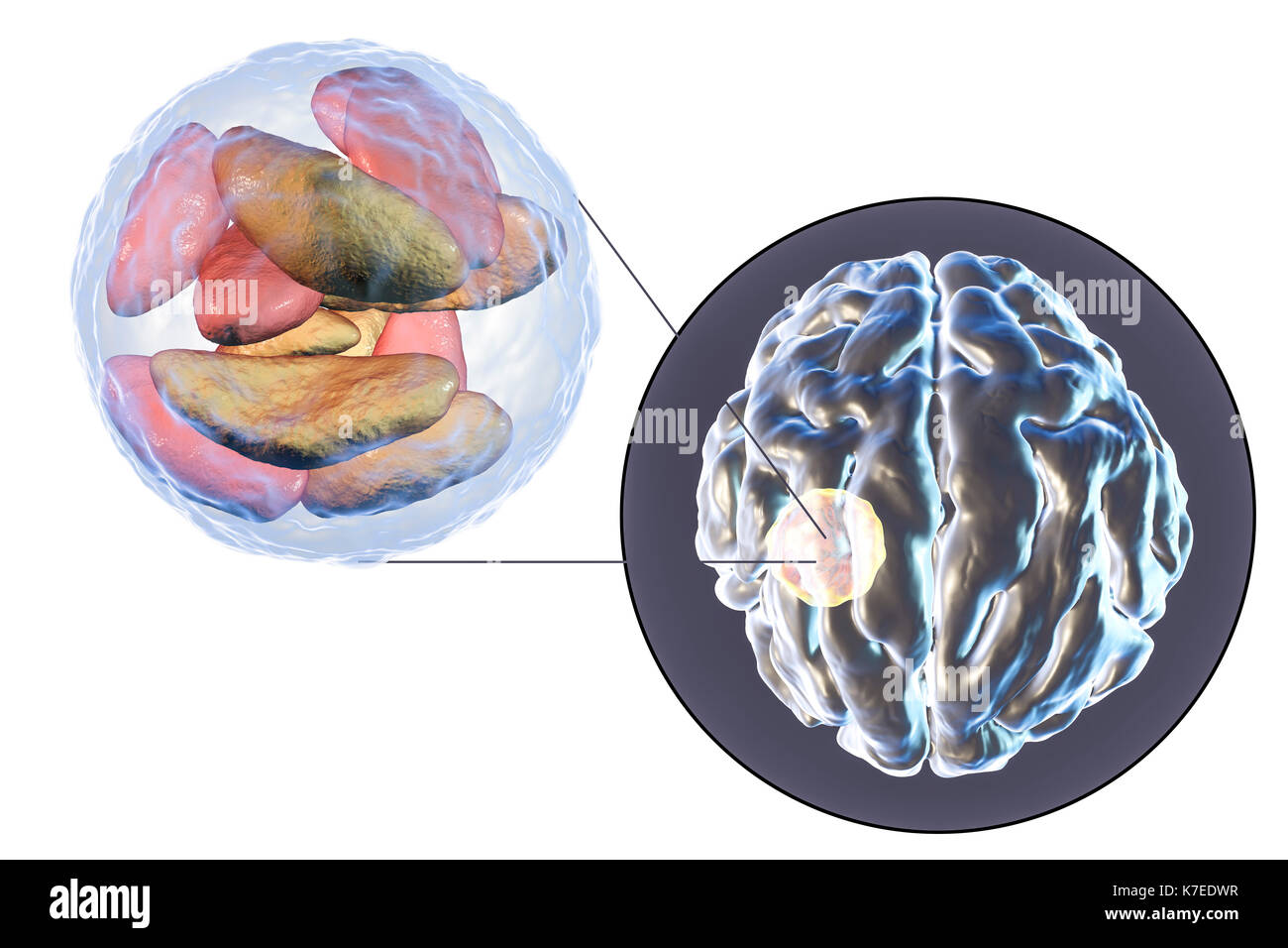 Neurotoxoplasmosis, computer illustration. Brain abscess caused by ...